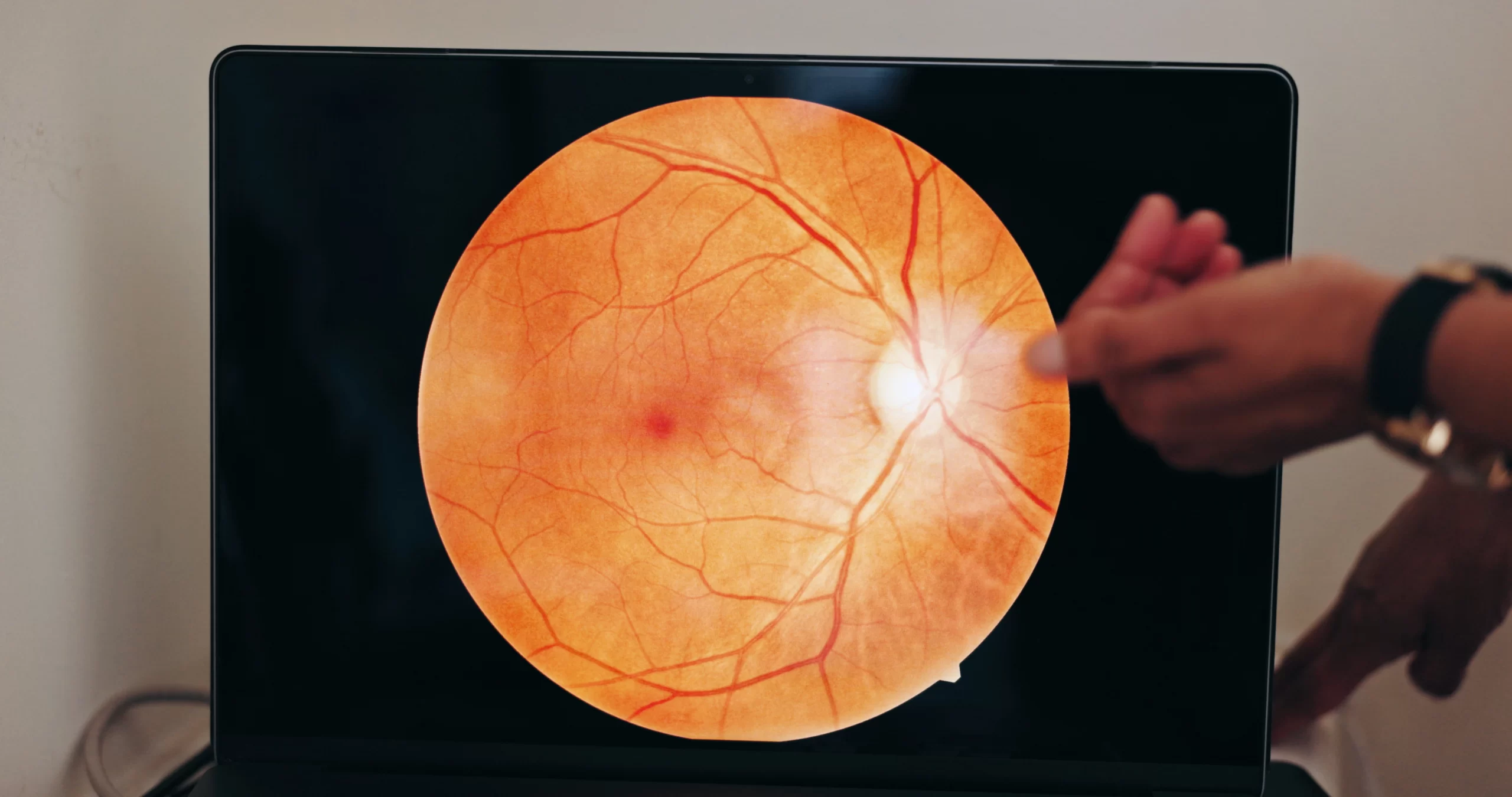 Diabetic Macular Edema Singapore | Dr. David Goh Eye Clinic